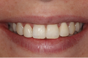 Composite Bonding – Hartley Dental Practice